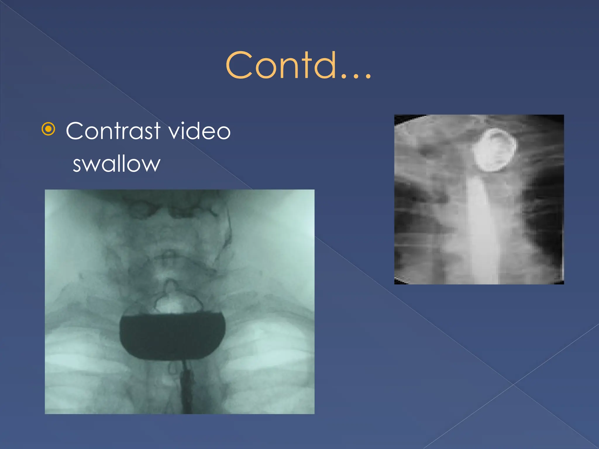 Pharyngeal pouches and its applied anatomy.pptx