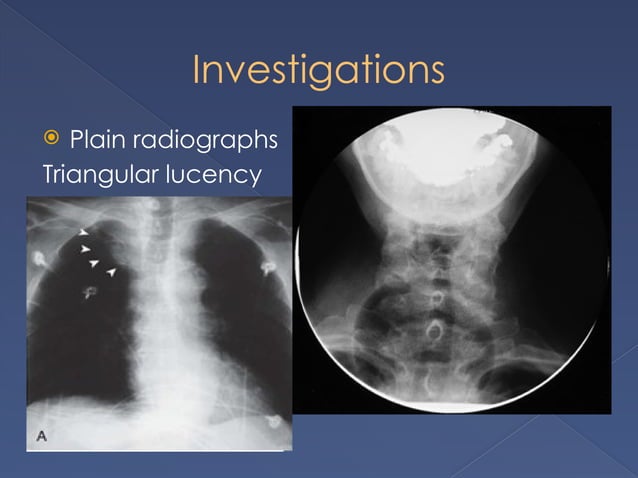 Pharyngeal pouches and its applied anatomy.pptx