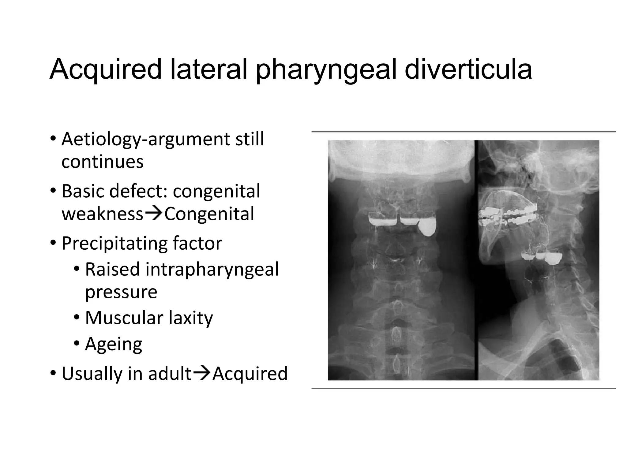 pharyngeal pouches uttam, pharyngoceles, laryngoceles.pptx