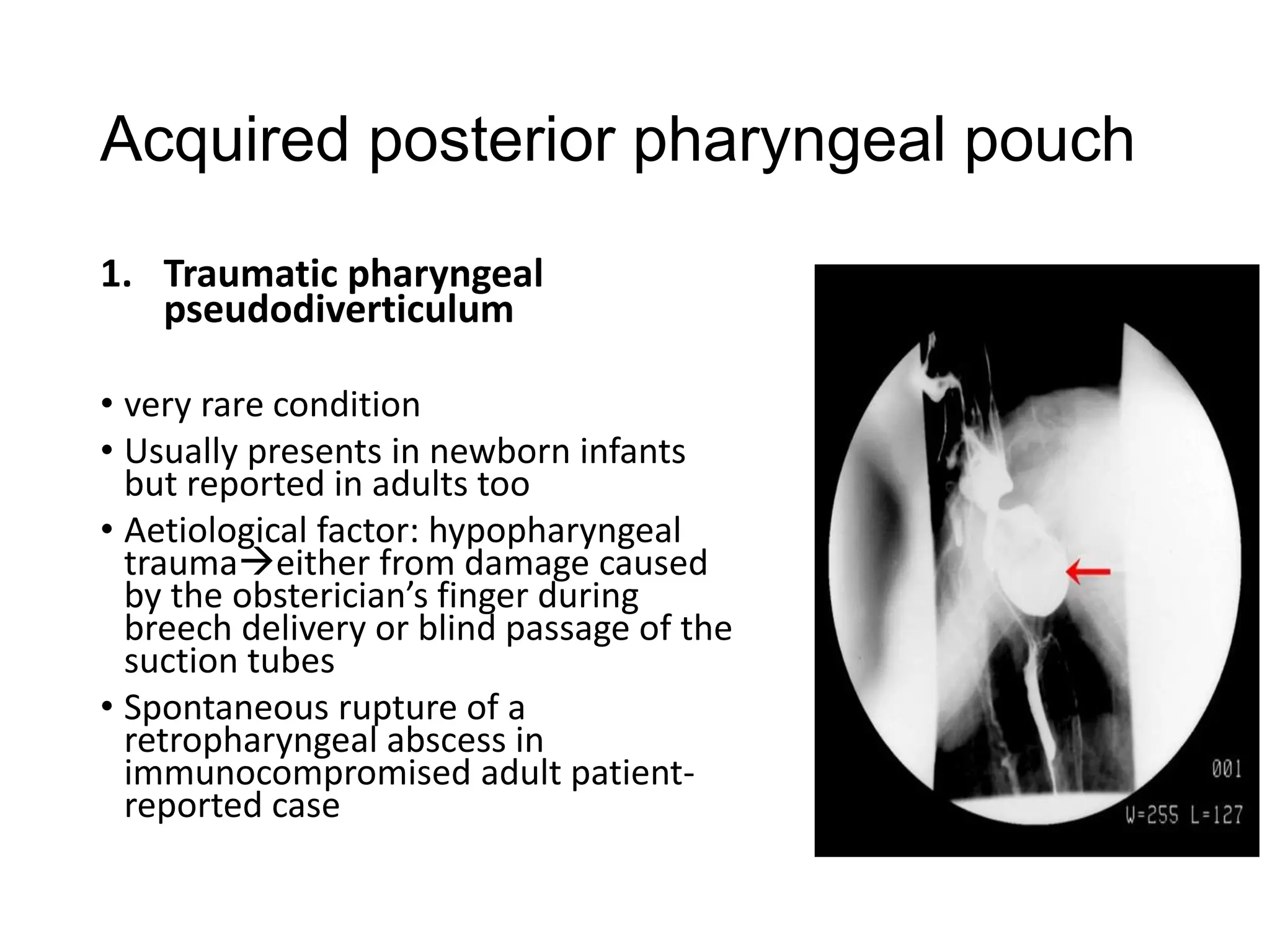 pharyngeal pouches uttam, pharyngoceles, laryngoceles.pptx
