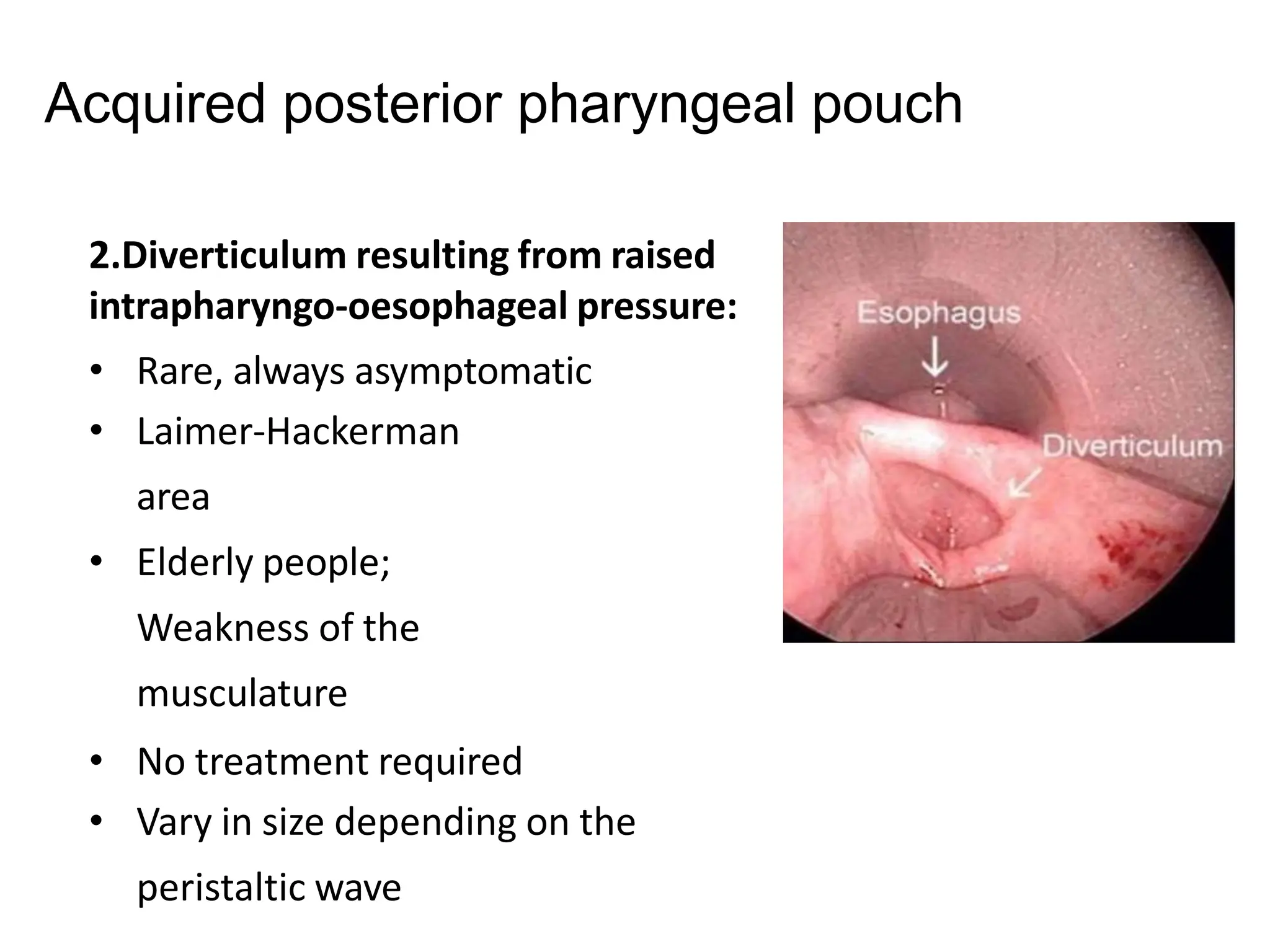 pharyngeal pouches uttam, pharyngoceles, laryngoceles.pptx