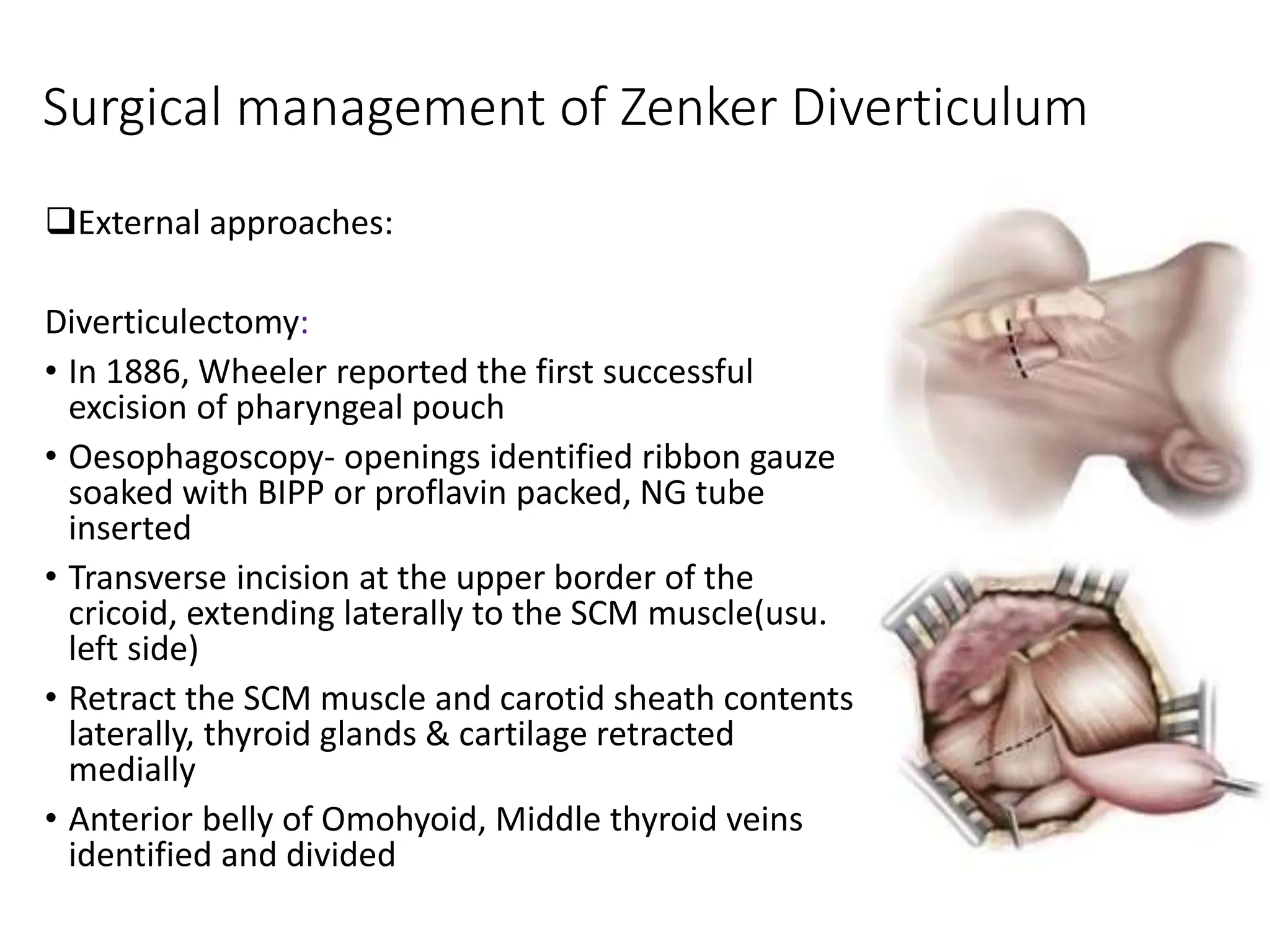 pharyngeal pouches uttam, pharyngoceles, laryngoceles.pptx
