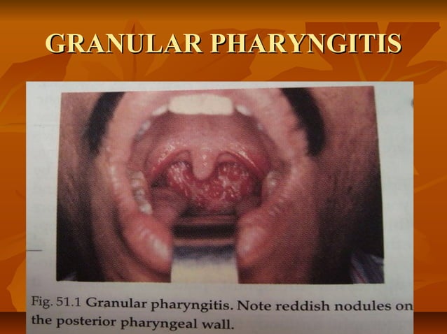 Pharyngitis | PPT | Ear, Nose and Throat Conditions | Diseases and ...