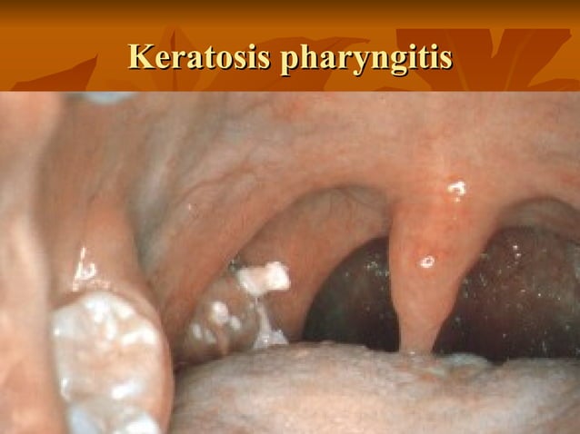Pharyngitis | PPT | Ear, Nose and Throat Conditions | Diseases and Conditions