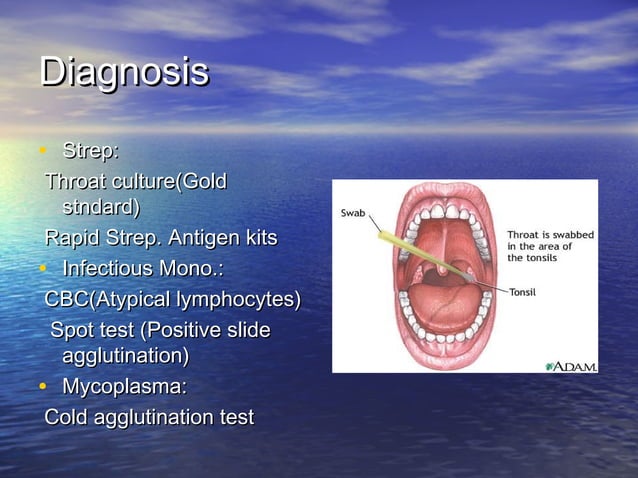 Pharyngitis | PPT
