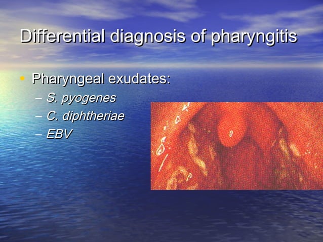 Pharyngitis | PPT