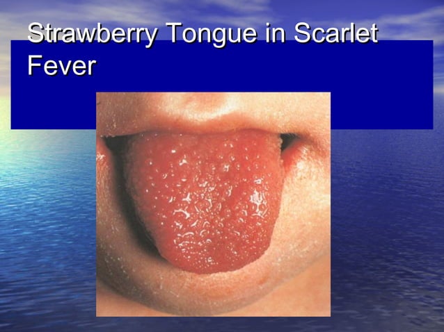 Pharyngitis | PPT