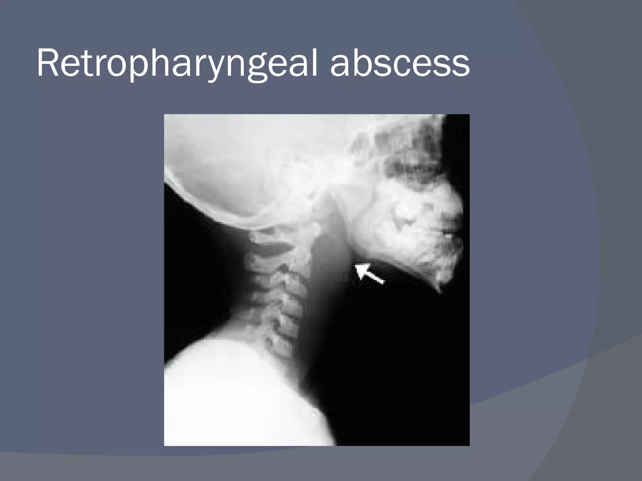 Acute Pharyngitis | PPT