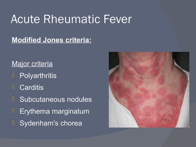 Acute Pharyngitis | PPT | Ear, Nose and Throat Conditions | Diseases ...