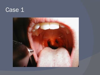 Acute Pharyngitis | PPT