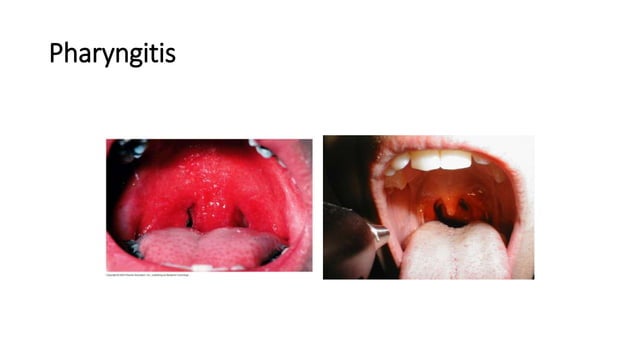 Pharyngitis | PPTX | Ear, Nose and Throat Conditions | Diseases and ...