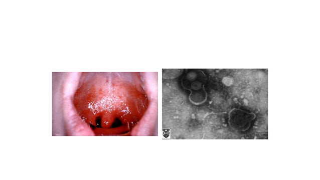 Pharyngitis | PPT