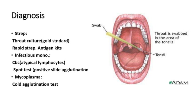 Pharyngitis | PPTX | Ear, Nose and Throat Conditions | Diseases and Conditions