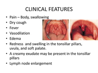 Exudative Pharyngitis