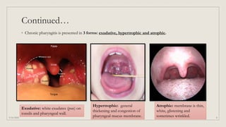Unveiling Pharyngitis: Causes, Symptoms, Diagnosis, and Treatment ...