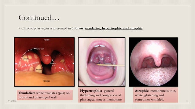 Unveiling Pharyngitis Causes Symptoms Diagnosis And Treatment Strategiespdf
