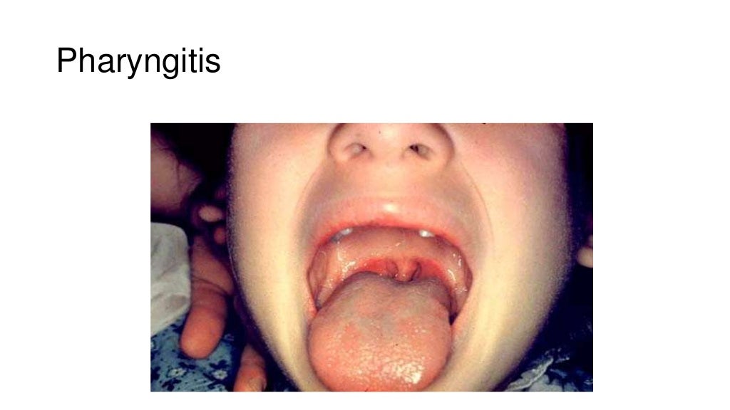 Pharyngitis, laryngitis