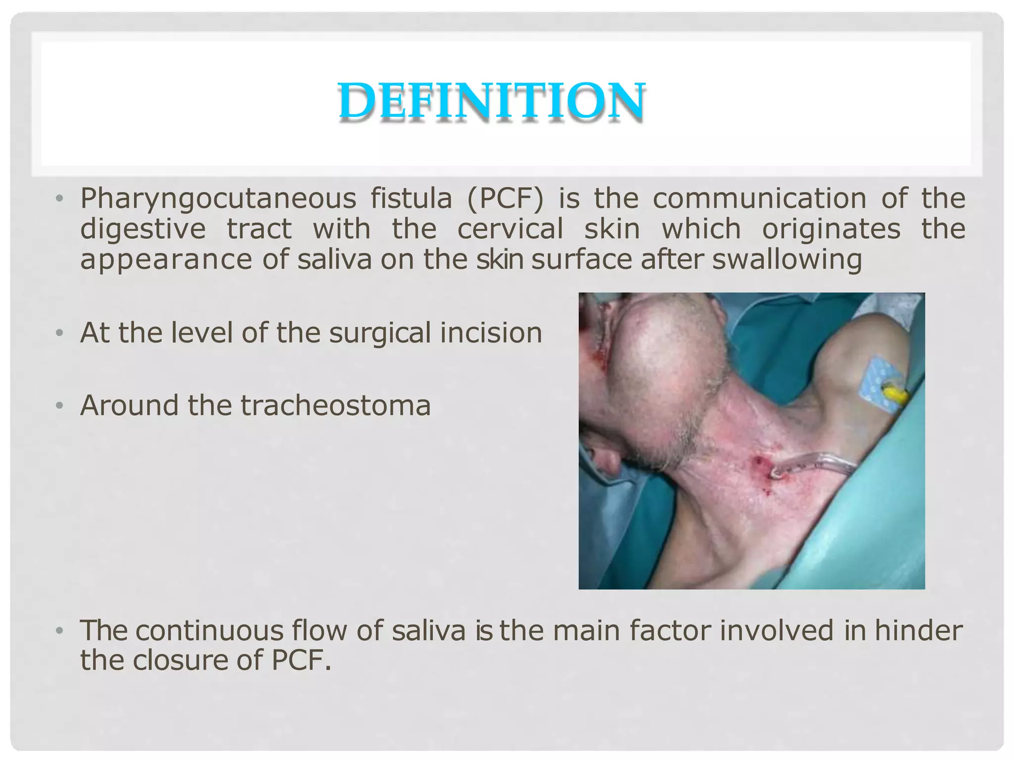 Pharyngocutaneous-fistula (1).pptx