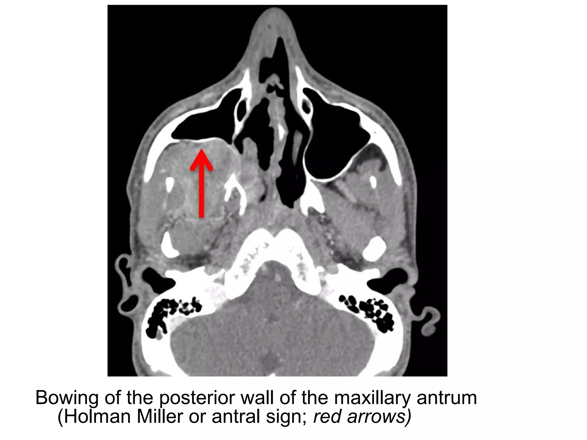 Diagnostic Imaging of Pharynx & Larynx | PPT