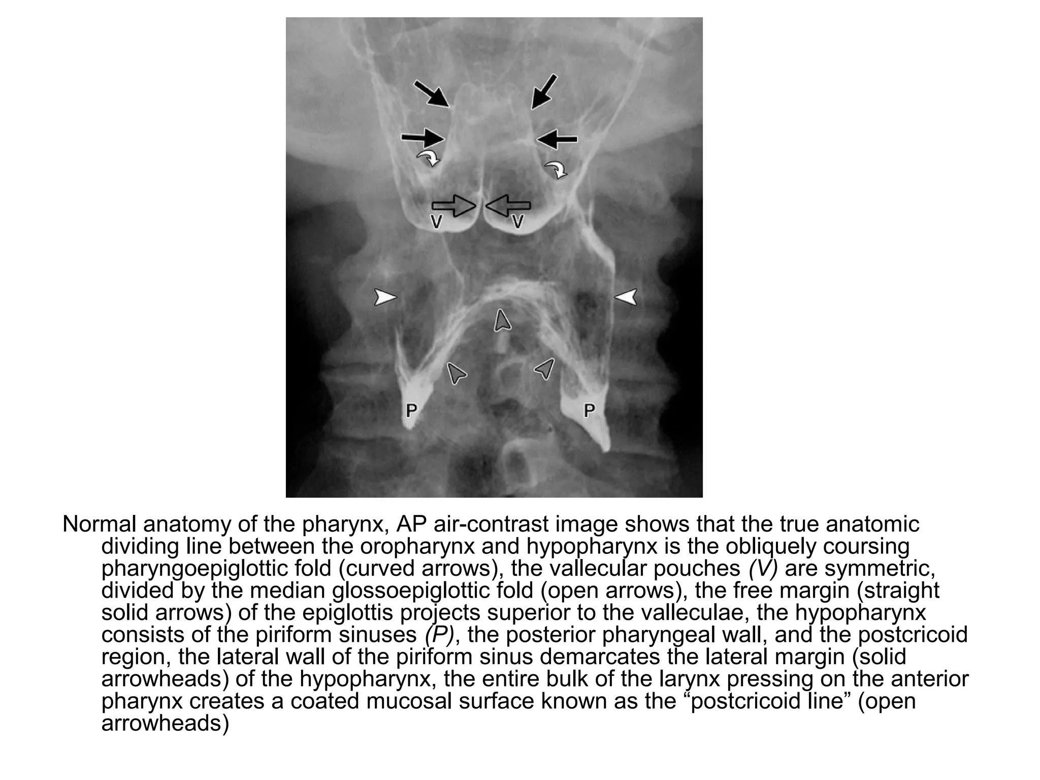 Diagnostic Imaging of Pharynx & Larynx | PPT