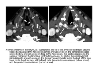Diagnostic Imaging of Pharynx & Larynx | PPT