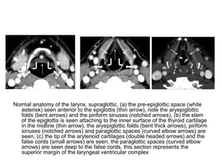 Diagnostic Imaging of Pharynx & Larynx | PPT