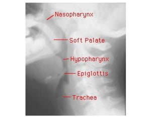 Hypopharynx Xray