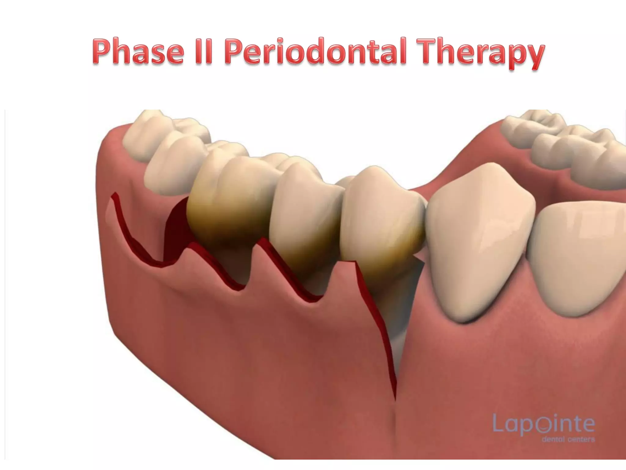 Phase II periodontal therapy | PDF