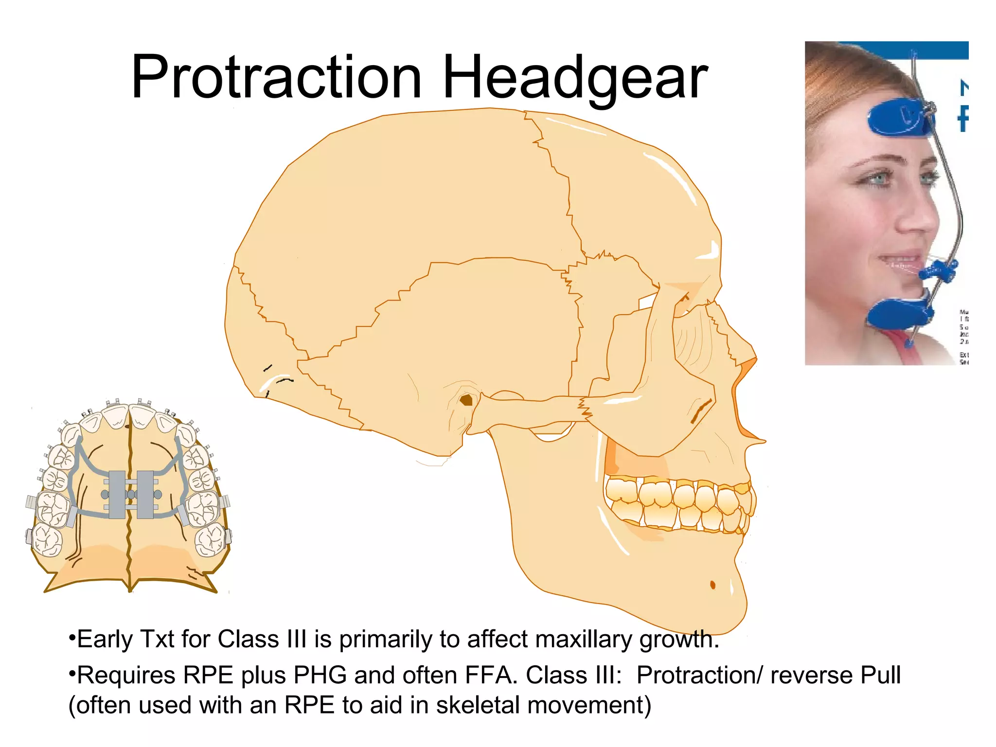Phase I Orthodontic treatment | PPT