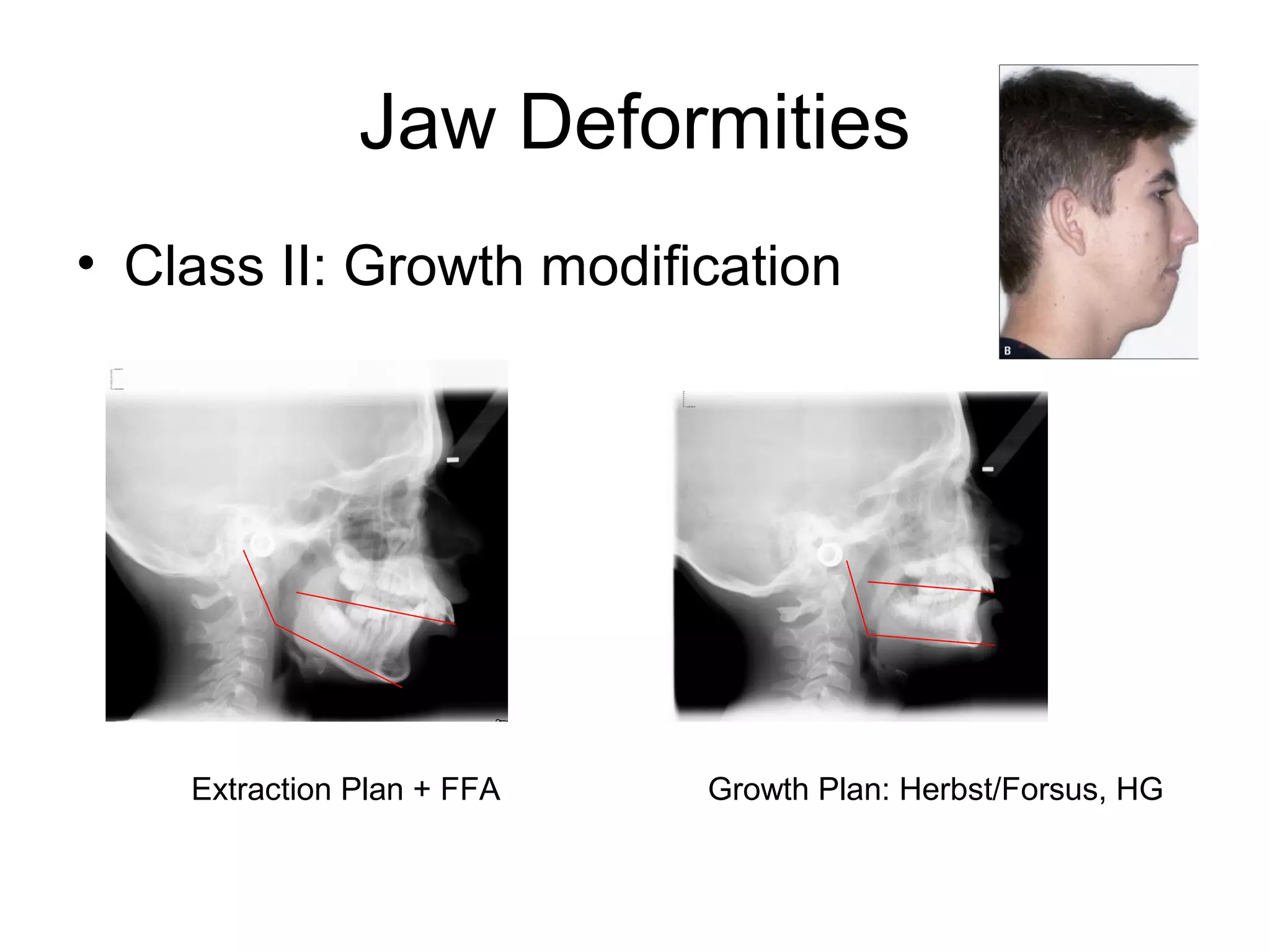 Phase I Orthodontic treatment | PPT