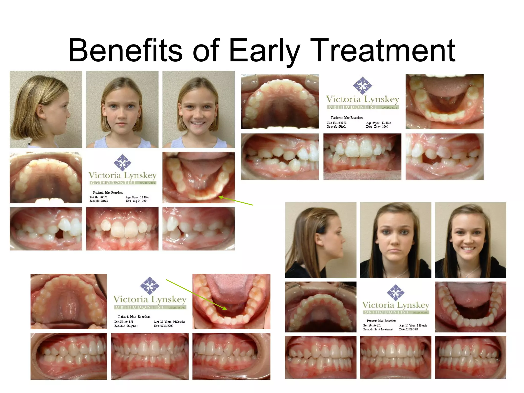 Phase I Orthodontic treatment | PPT