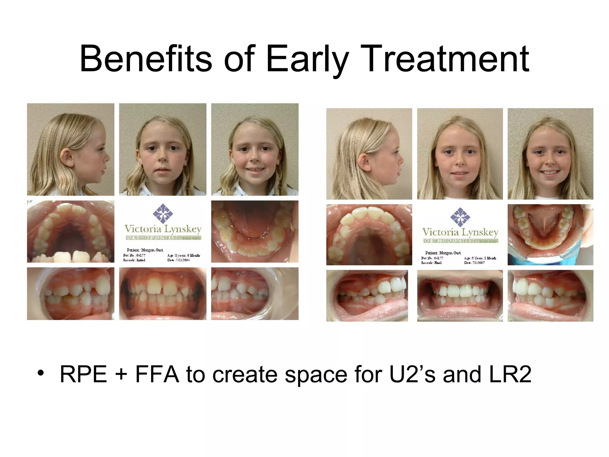 Phase I Orthodontic treatment | PPT