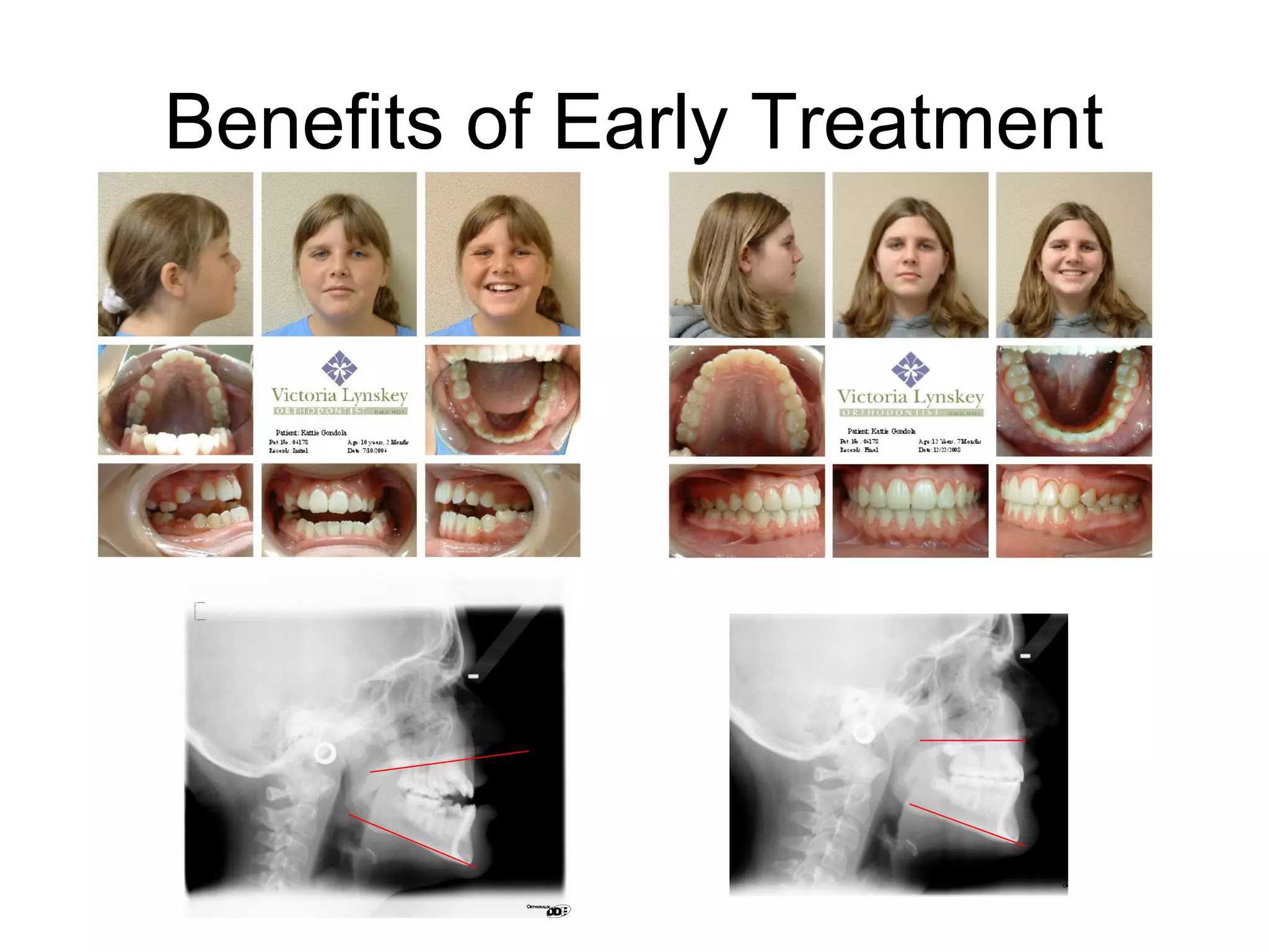 Phase I Orthodontic treatment | PPT