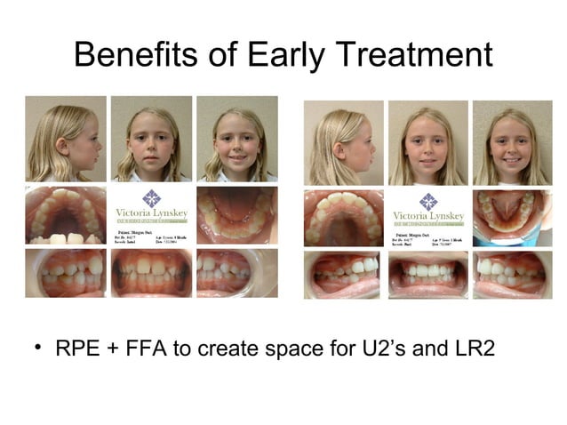 Phase I Orthodontic treatment | PPT | Dental Health | Diseases and ...