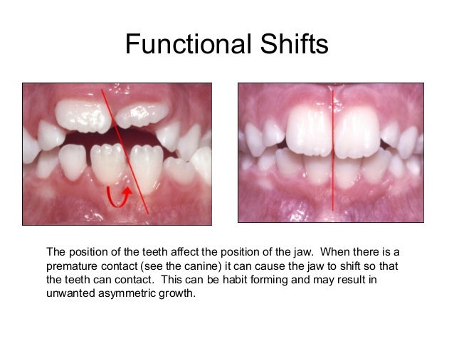 Phase I Orthodontic treatment