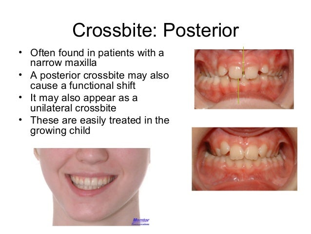 Gallery Unilateral Posterior Crossbite