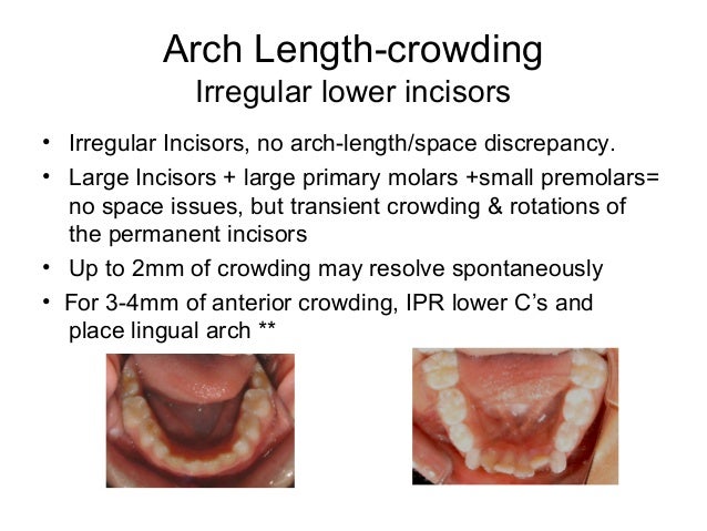 Phase I Orthodontic treatment
