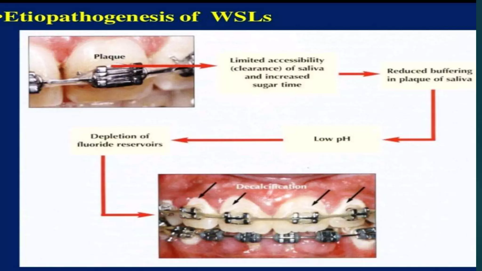 CONTROL OF WHITE SPOT LESIONS USING FLUORIDE VARNISH IN ORTHODONTIC ...