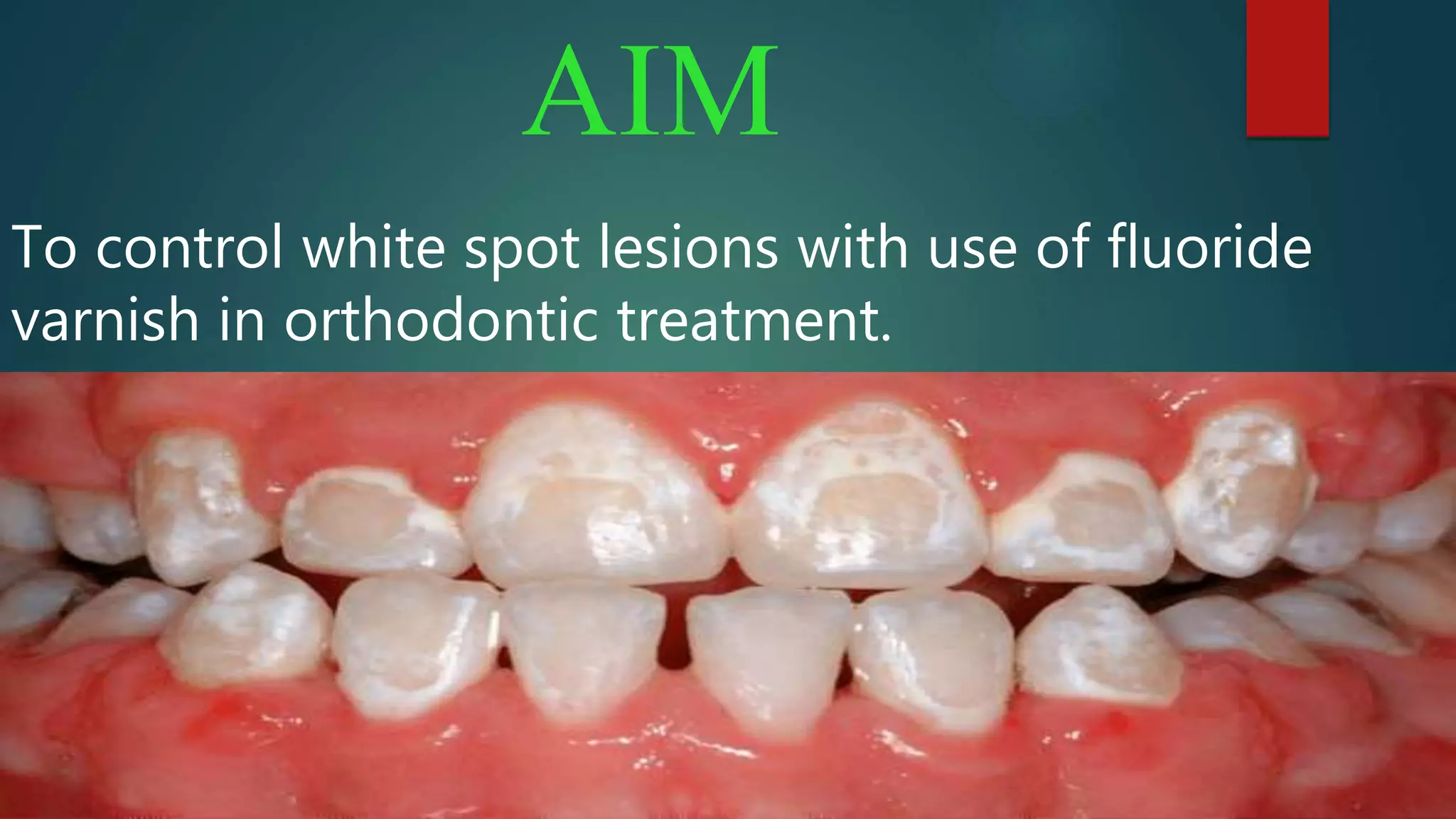 CONTROL OF WHITE SPOT LESIONS USING FLUORIDE VARNISH IN ORTHODONTIC ...