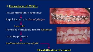 CONTROL OF WHITE SPOT LESIONS USING FLUORIDE VARNISH IN ORTHODONTIC ...