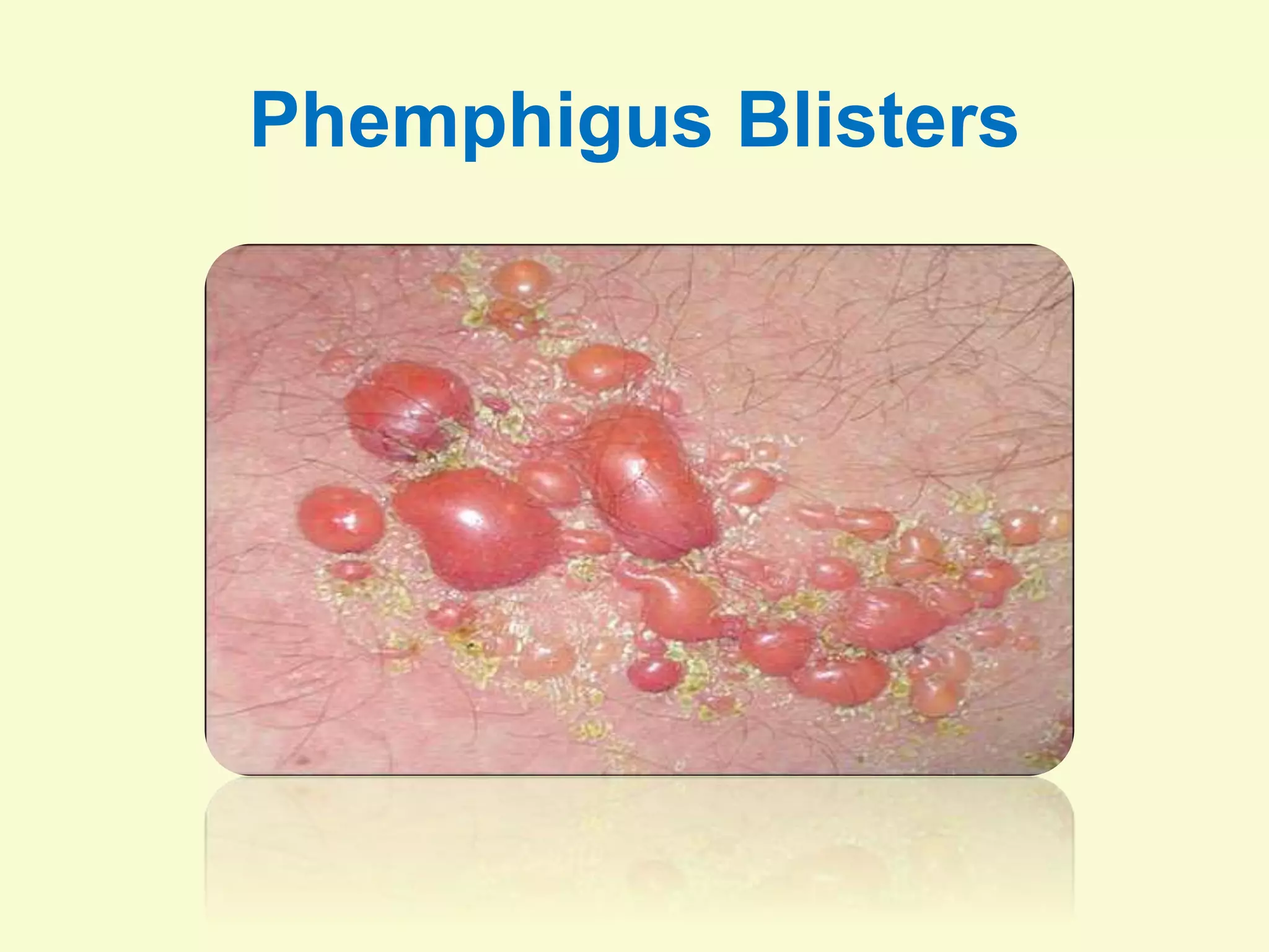 Phemphigus | PPTX | Skin and Dermatology | Diseases and Conditions