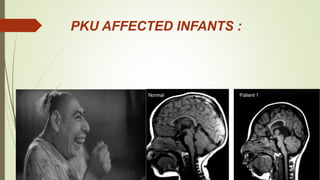 Phenylketonuria # | PPTX
