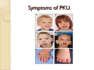 Phenylketonuria (PKU) | PPT