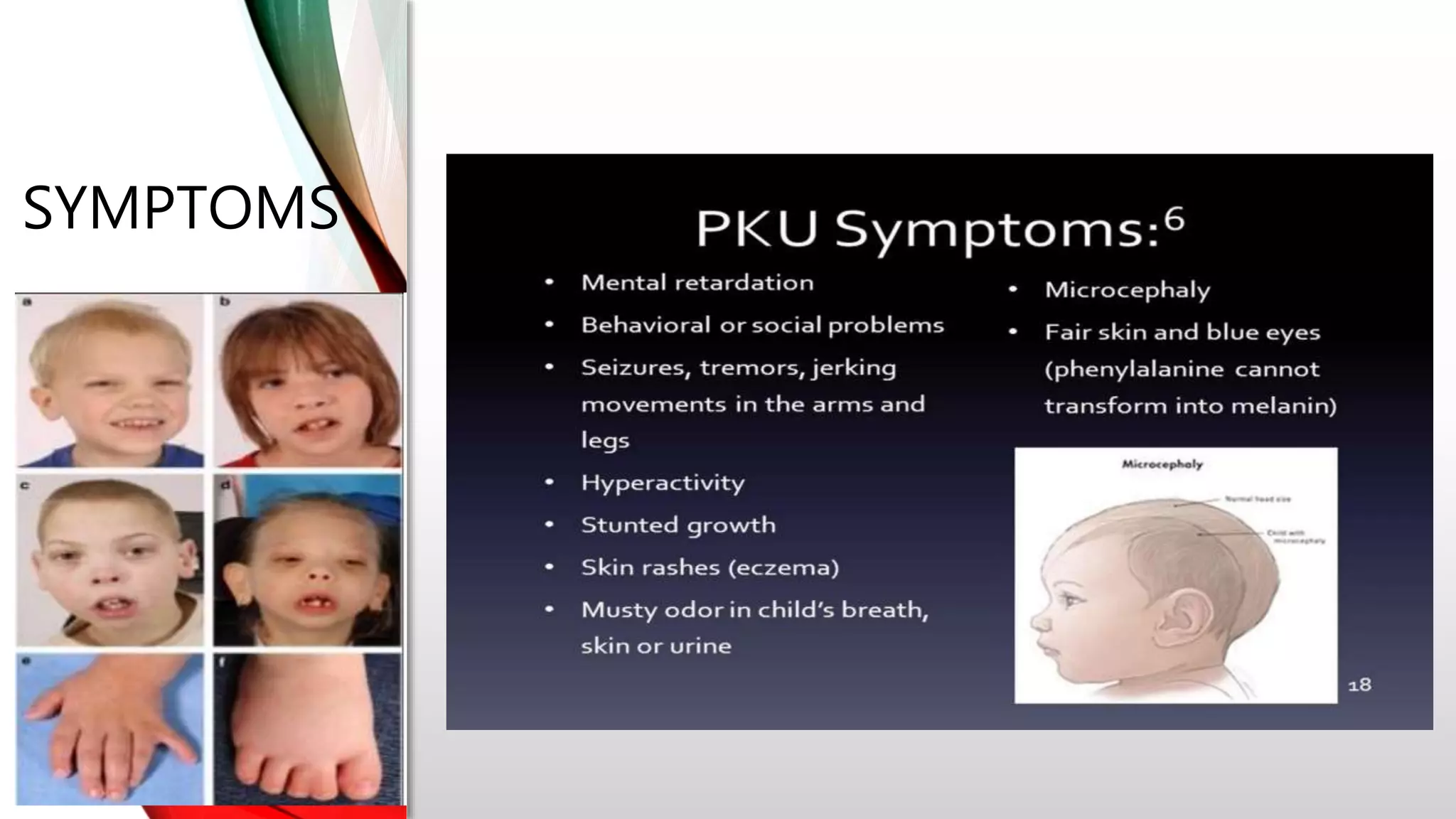 Phenylketonuria(pku) new | PPTX