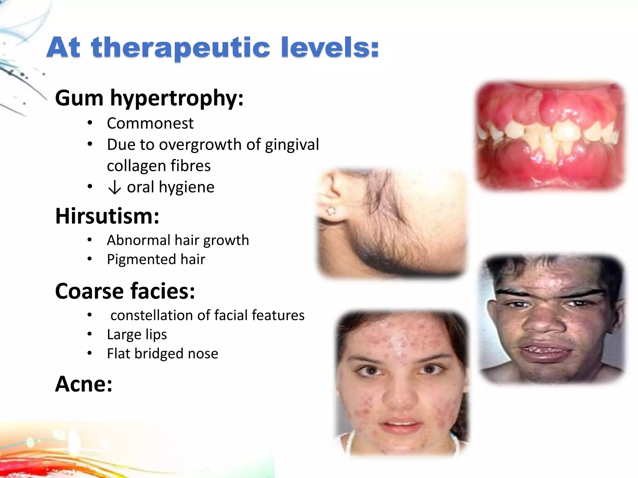 Adverse effect of Phenytoin | PPTX