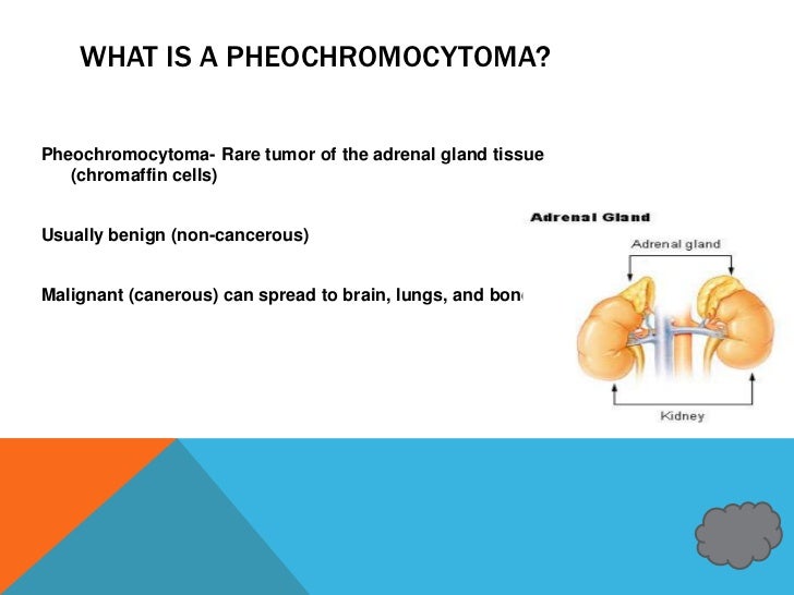 Pheochromocytoma