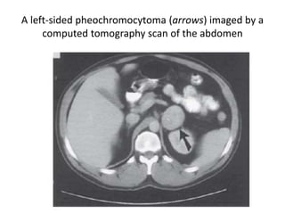 Pheochromocytoma | PPTX
