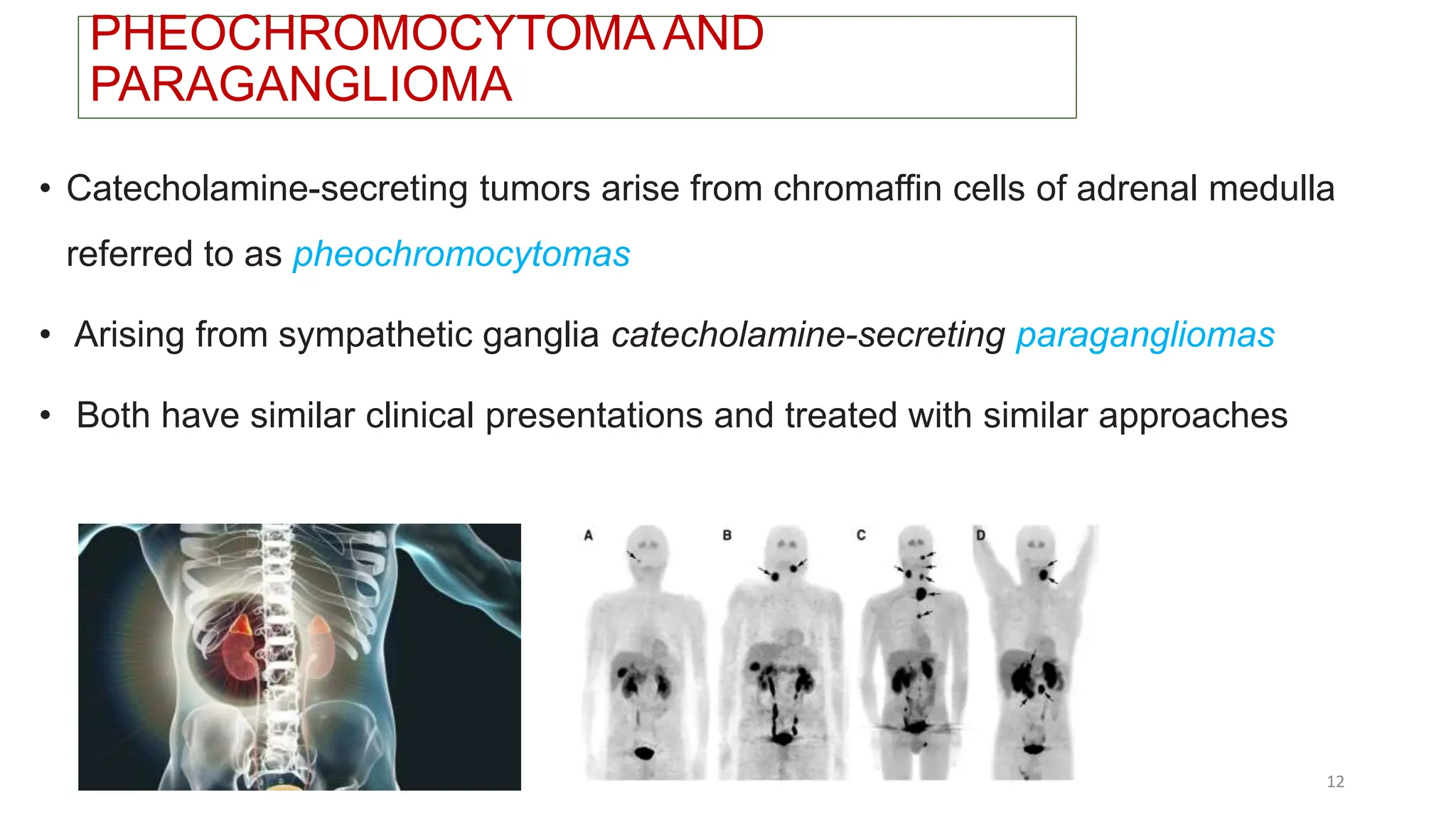 PHEOCHROMOCYTOMA.pptx by dr kavya dnb anesthesia | PPTX
