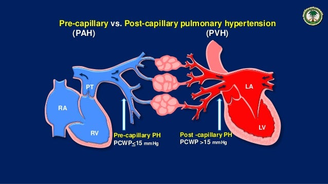 Pulmonary Hypertension for general physicians