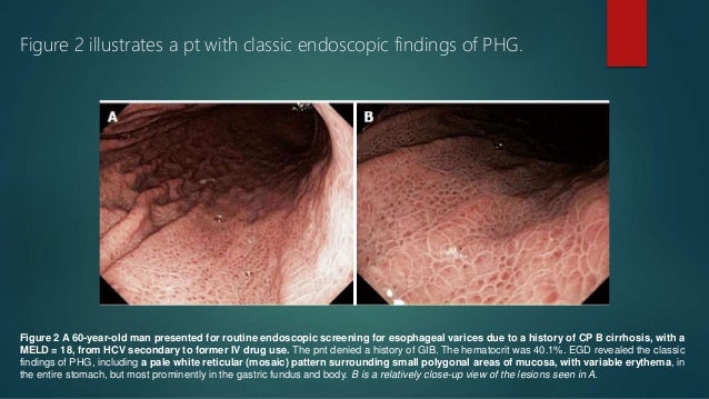 PORTAL HYPERTENSIVE GASTROPATHY